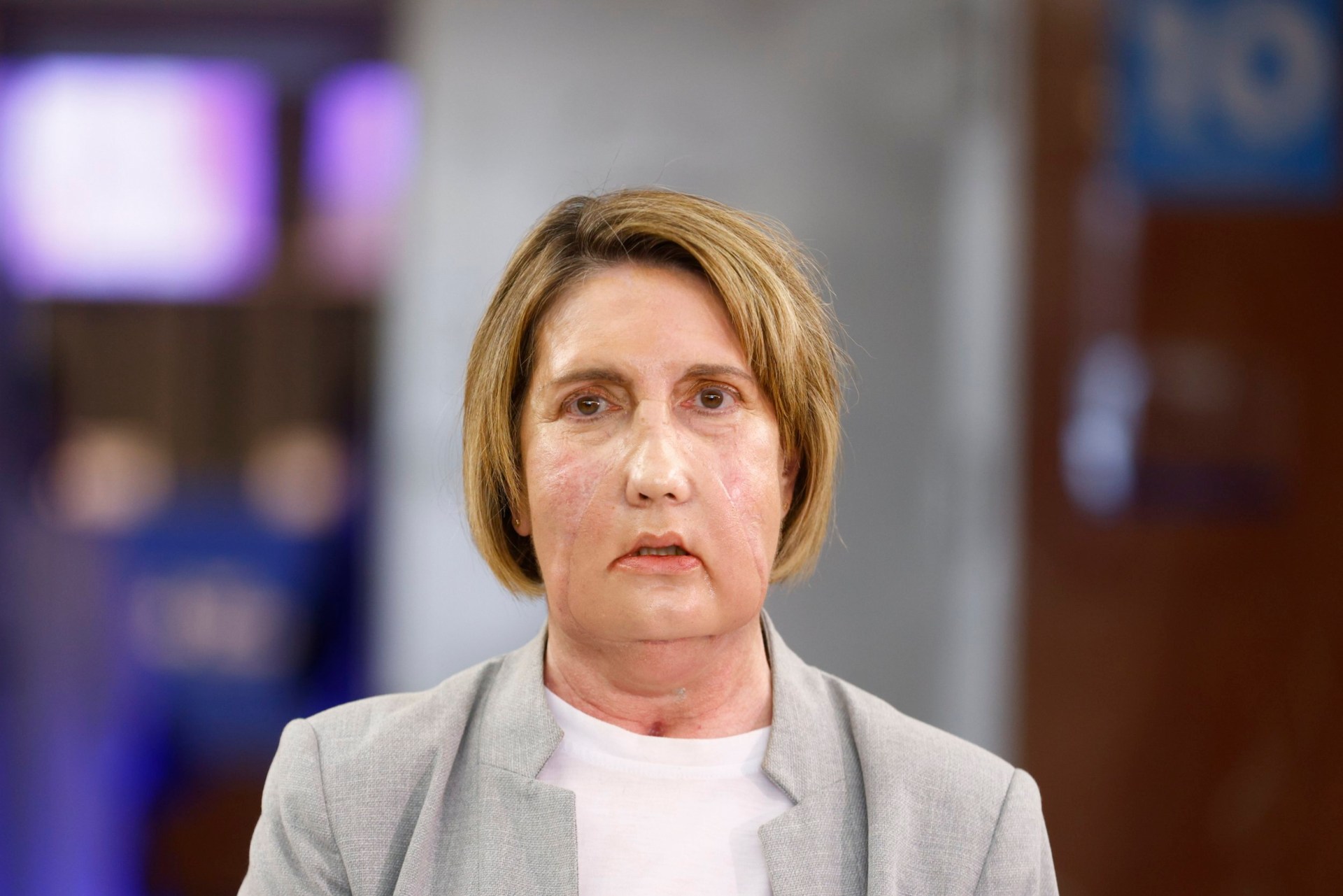 Woman who suffered flesh-eating disease after insect bite receives a ...