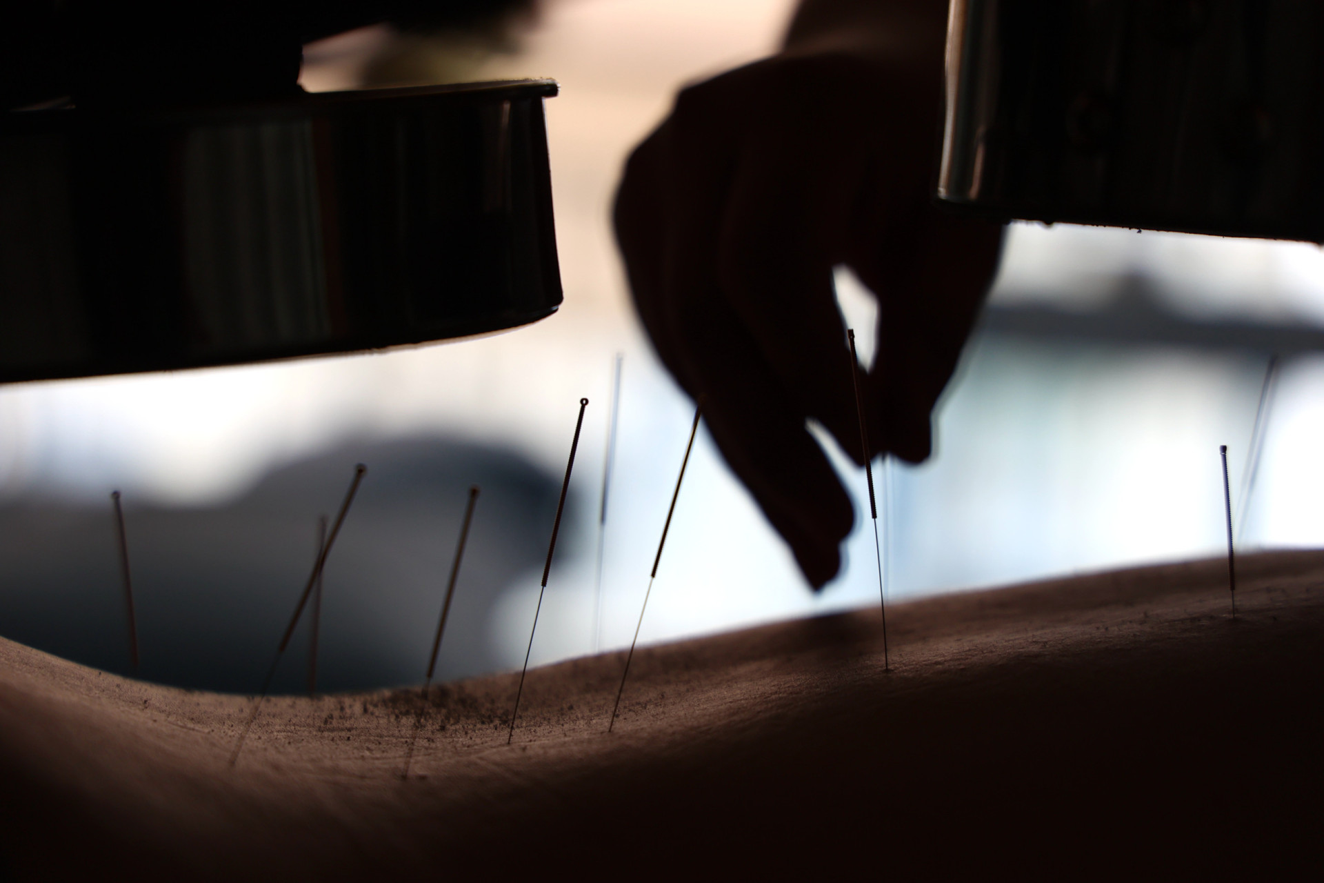 How acupuncture is changing modern medicine