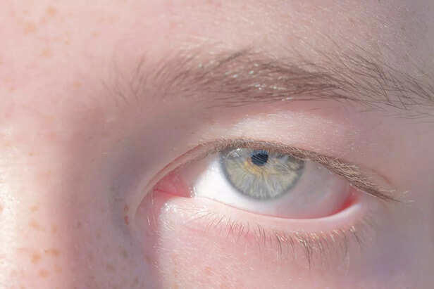 Glaucoma warning signs that can lead to vision loss