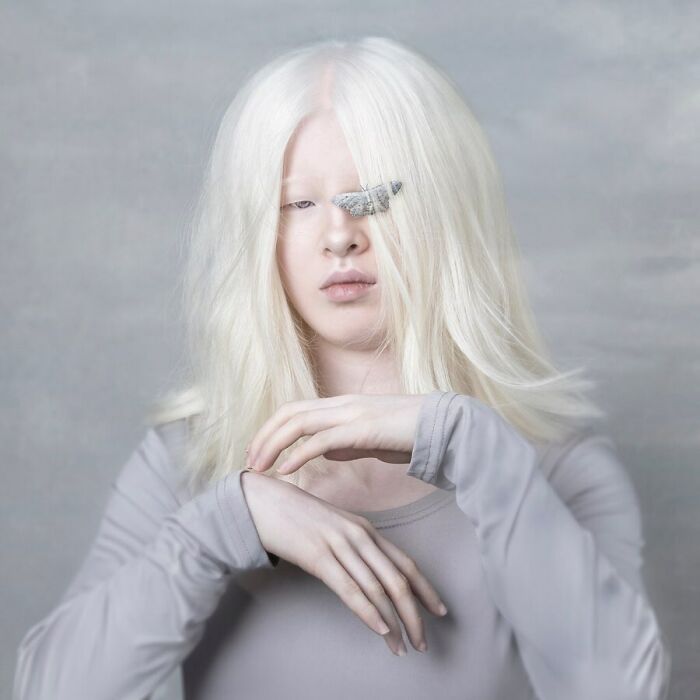 Abandoned as a baby due to albinism, Xueli grew up to become a Vogue ...