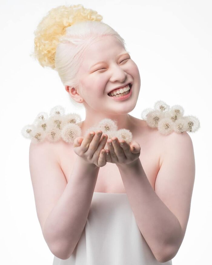 Abandoned as a baby due to albinism, Xueli grew up to become a Vogue ...