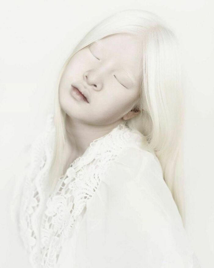 Abandoned as a baby due to albinism, Xueli grew up to become a Vogue ...
