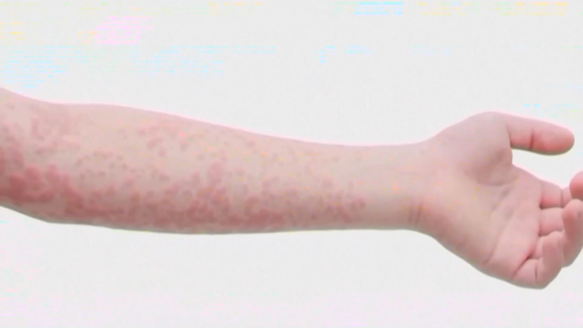 Union County child tests positive for measles in county’s first ...