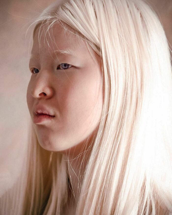 Abandoned as a baby due to albinism, Xueli grew up to become a Vogue ...