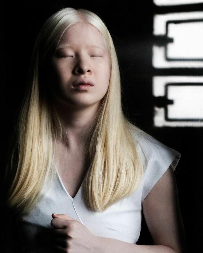 Abandoned as a baby due to albinism, Xueli grew up to become a Vogue ...
