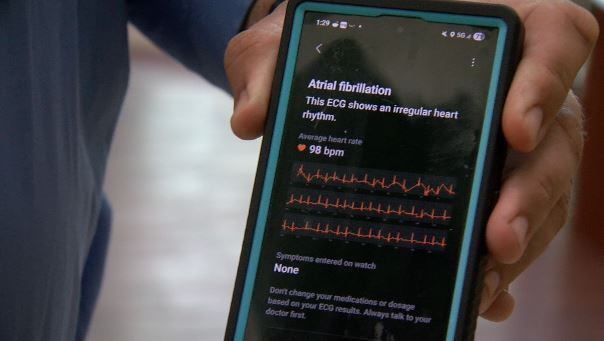 Memorial Health shares how smart watch alerted patient to AFib