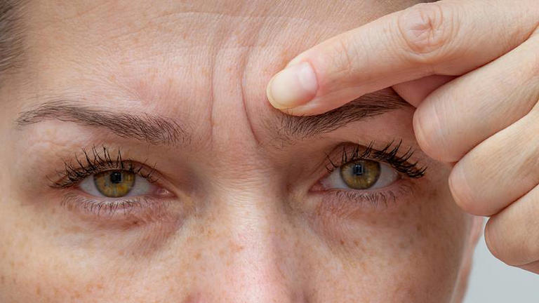 Anti-Aging ohne Spritze: Die besten Pflaster für die Zornesfalte