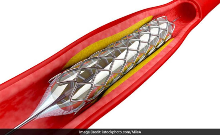 What should you avoid after a stent implant? Cardiologist shares tips ...