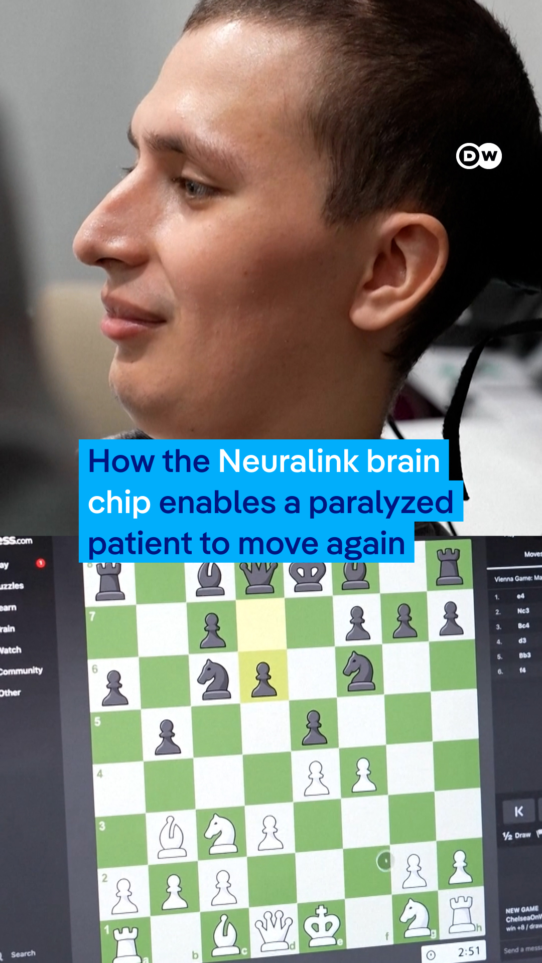 How the Neuralink brain chip enables a paralyzed patient to move again