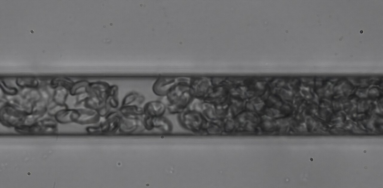 'Stiff' cells provide new explanation for differing symptoms in sickle ...