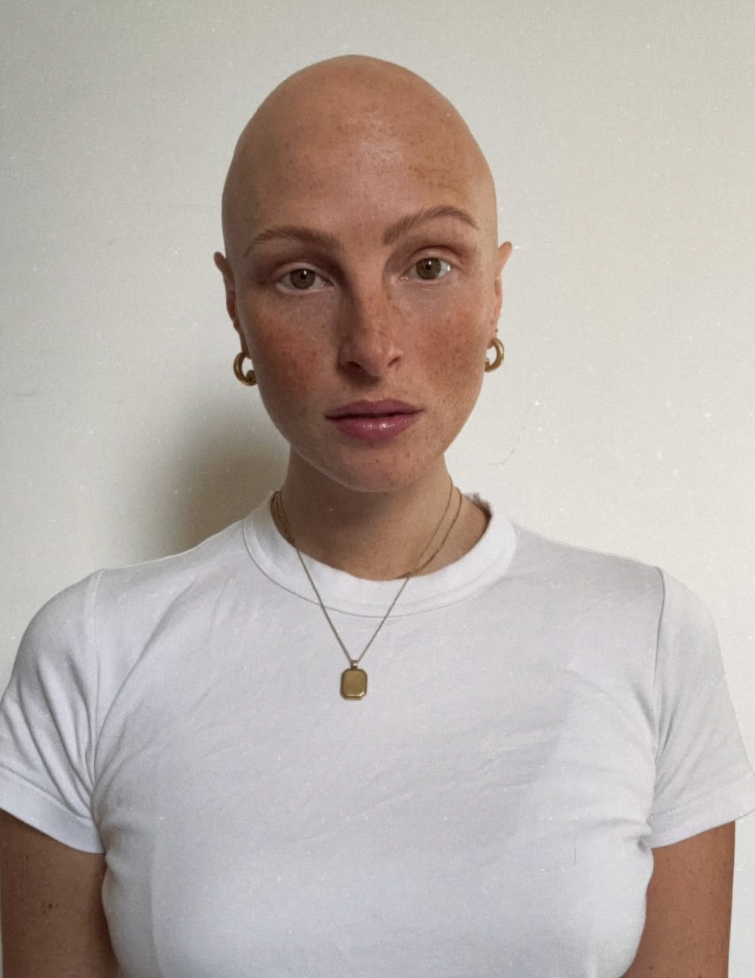 Should female hair loss be seen as a disability?