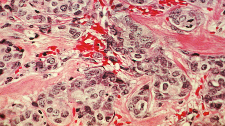 National Cancer Institute tests ivermectin on cancer cells, rattling ...