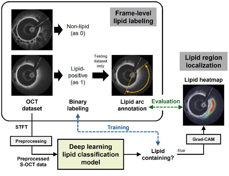 Combining AI with optical coherence tomography shows potential for ...