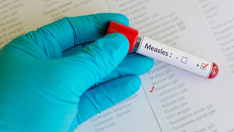 Measles outbreaks: What to know about the signs, symptoms
