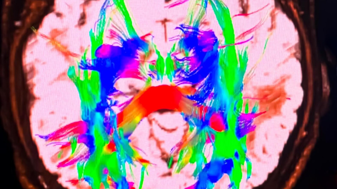 Wild new study says LSD brain chaos might actually prevent seizures