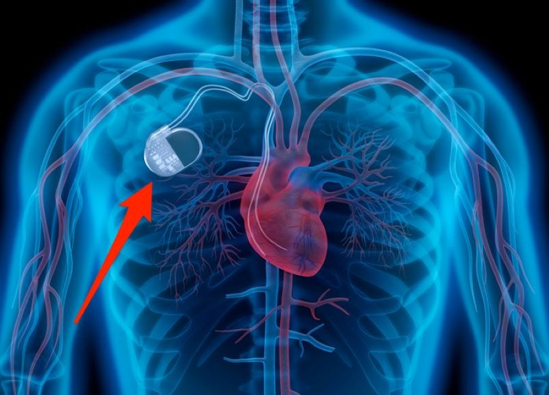 Your body is a tracking device: How a pacemaker became the biggest clue ...