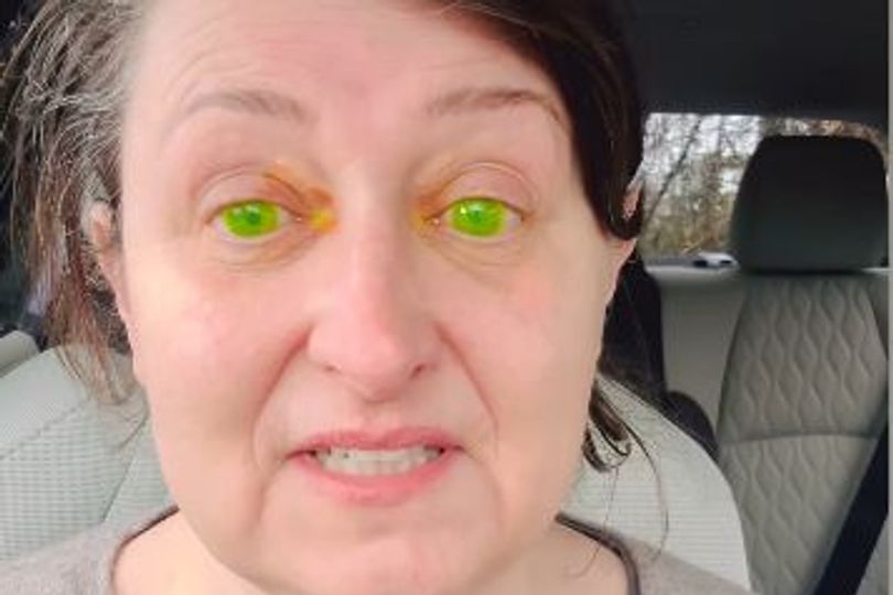 Mum's eyes turn fluorescent alien green after shocking Galway hospital ...