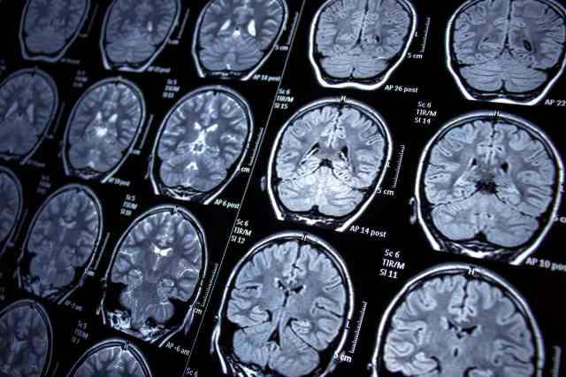 Research shows how a common form of trauma can seriously alter brain ...