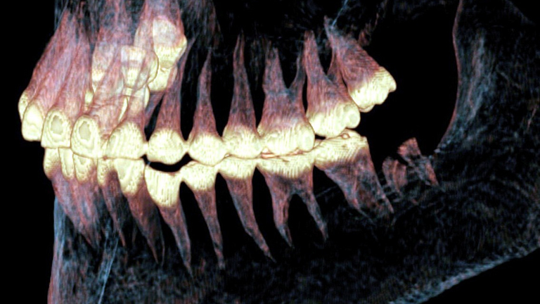 2,500-year-old 'primitive prosthetic' found on jaw of mummified ...