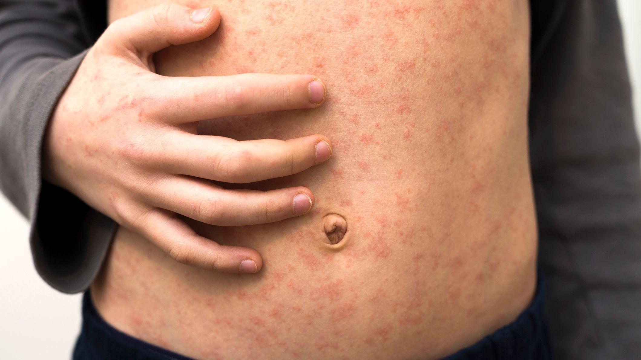 Signs Enfield measles outbreak is 'stabilising'