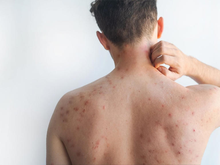 ¿Una inyección, triple protección? La vacuna que frena sarampión ...