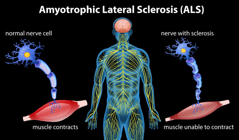 ALS diagnosis: Symptoms, progression, and survival rates explained