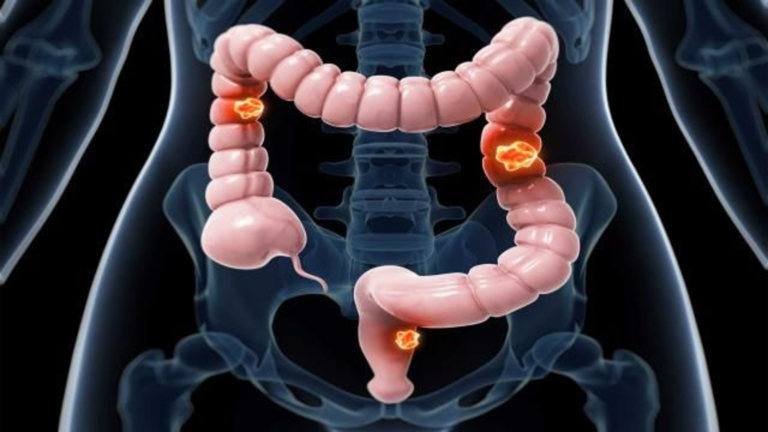 The common colon cancer sign you need to look out for