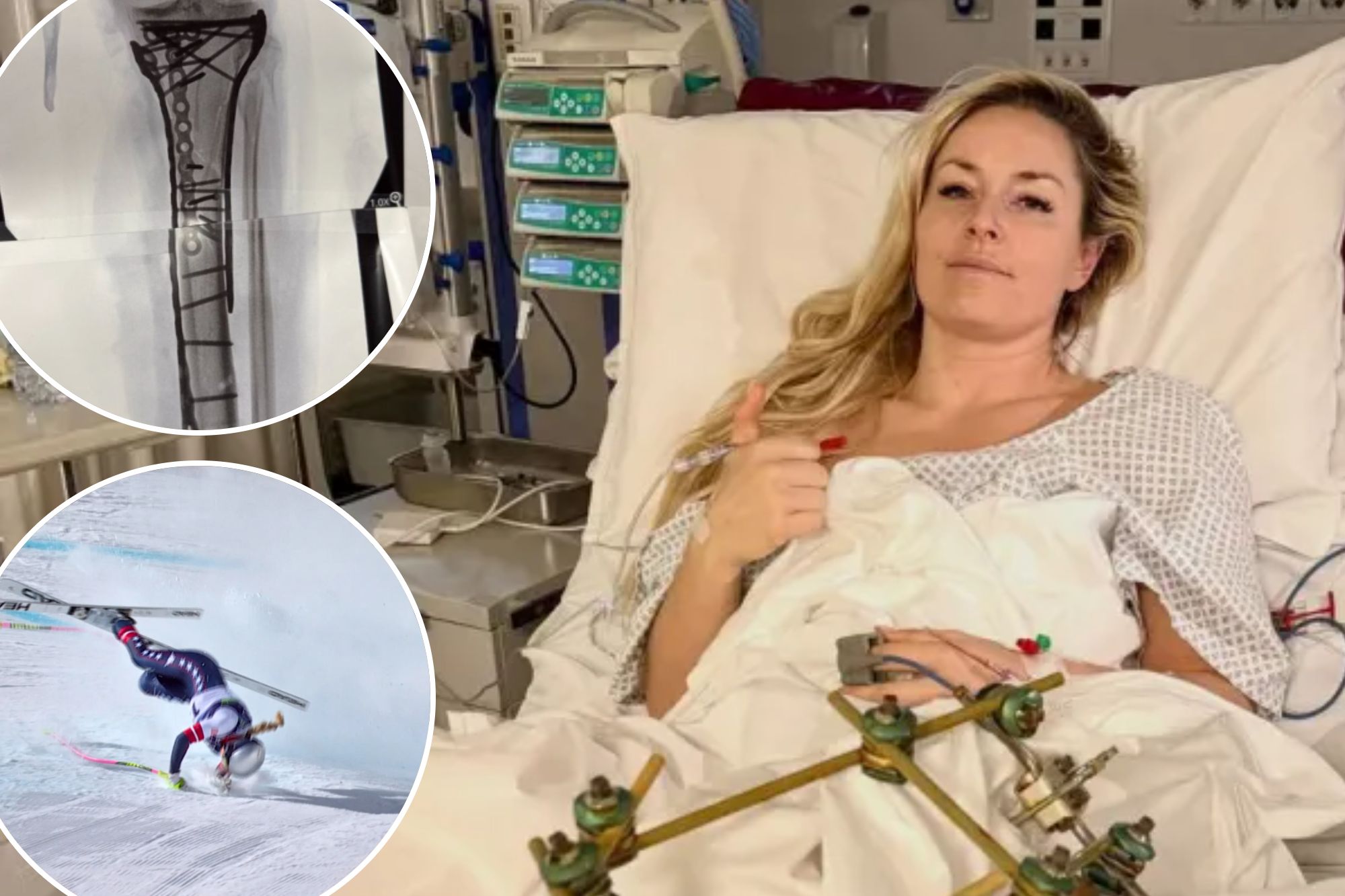 Lindsey Vonn’s gory update after latest post-Olympic crash surgery ...