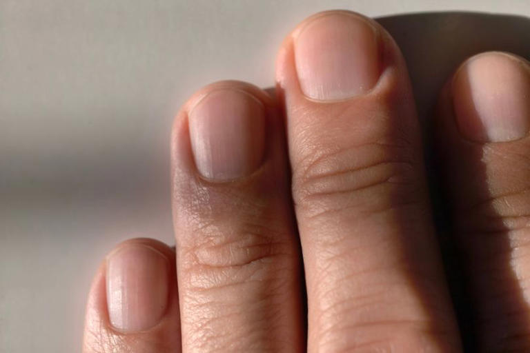 Finger symptom could be heart failure warning sign