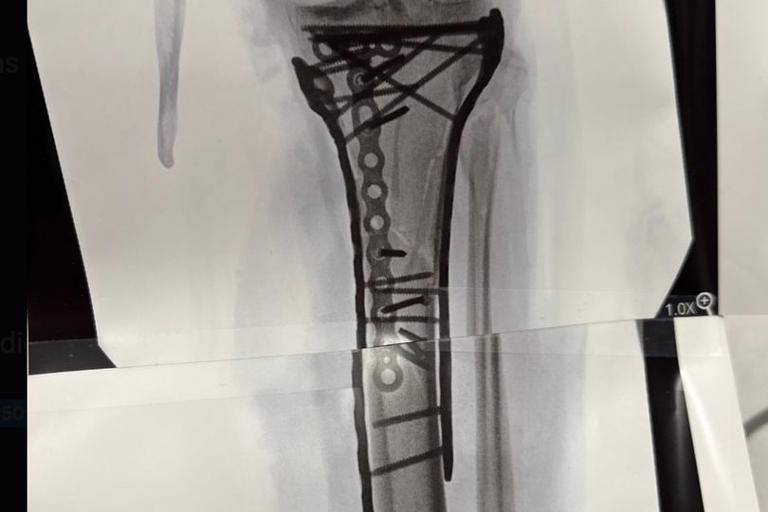 Lindsey Vonn needed 6-hour surgery to avoid amputation as 'luck' saves leg
