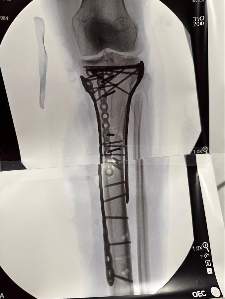 Lindsey Vonn shares graphic X-ray of broken leg after 2026 Olympics injury