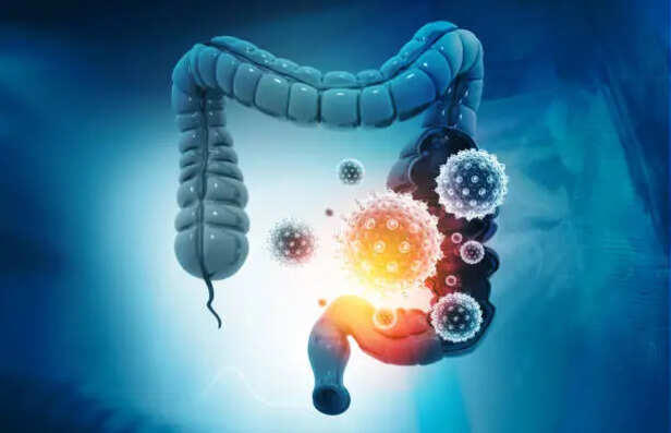 Why young adults face rising bowel cancer