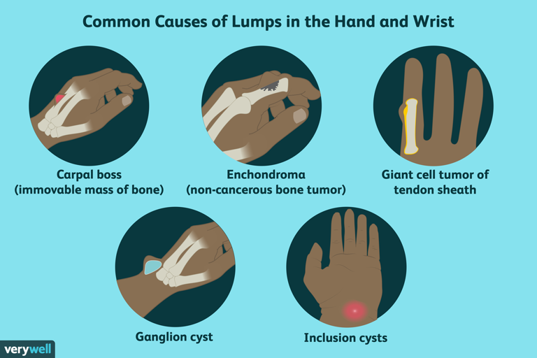 What's that lump? 10 reasons for a bump on your wrist