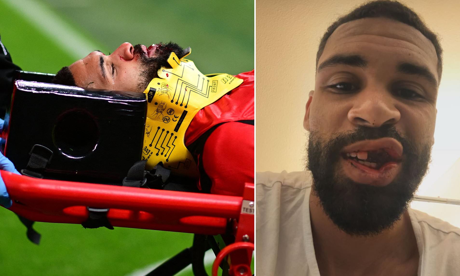 Ruben Loftus-Cheek shares gruesome picture after losing several teeth ...