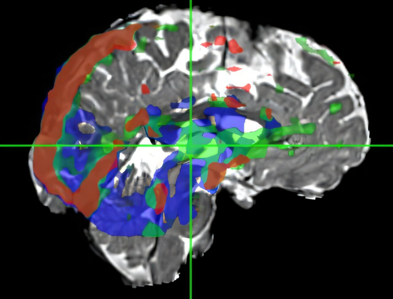 New MRI technique maps fluid velocity distribution in the brain