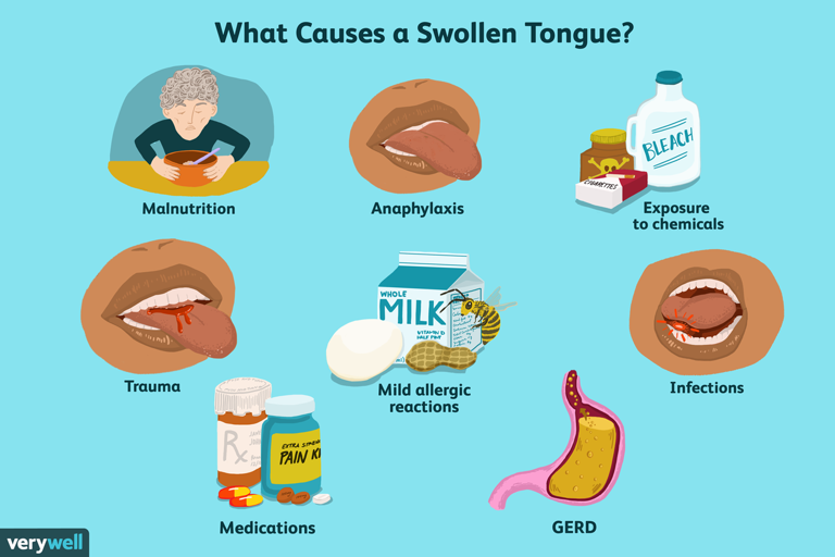 How to identify these 12 causes of a swollen tongue