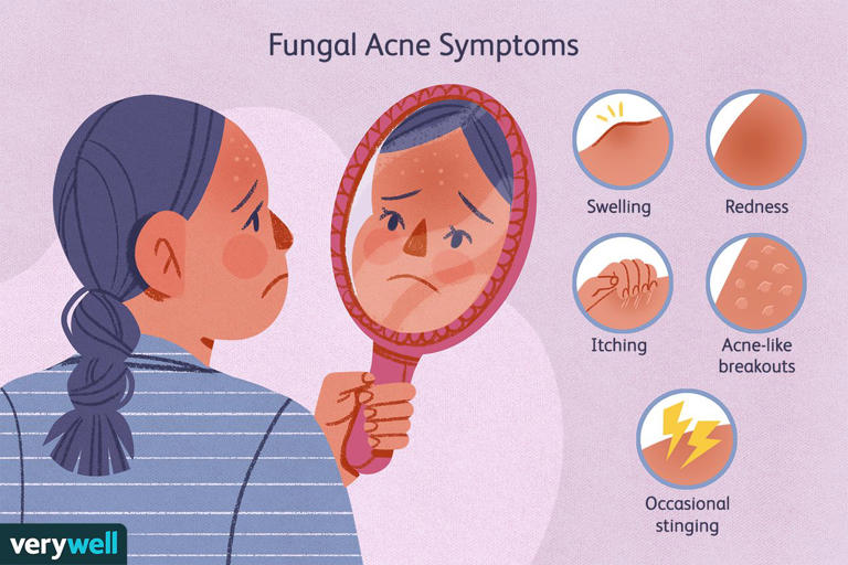 How to recognize and clear up fungal acne