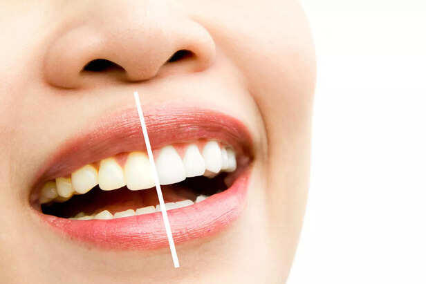 Are you overdoing DIY teeth whitening without realizing it?