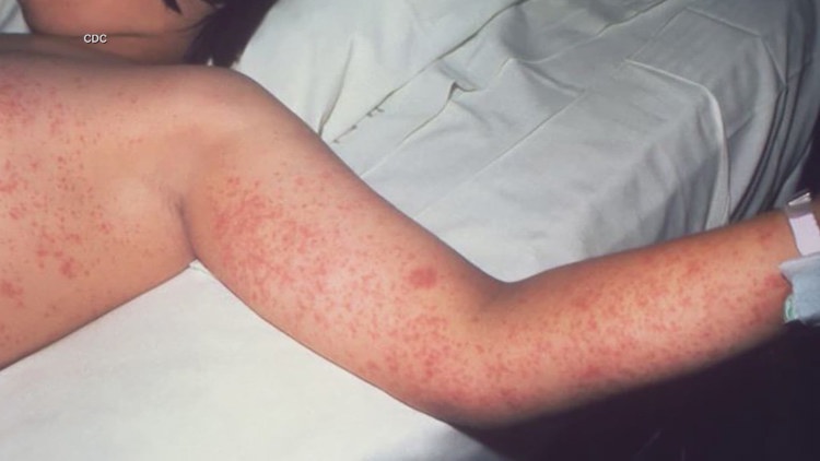 2 more measles cases identified in North Texas, officials say
