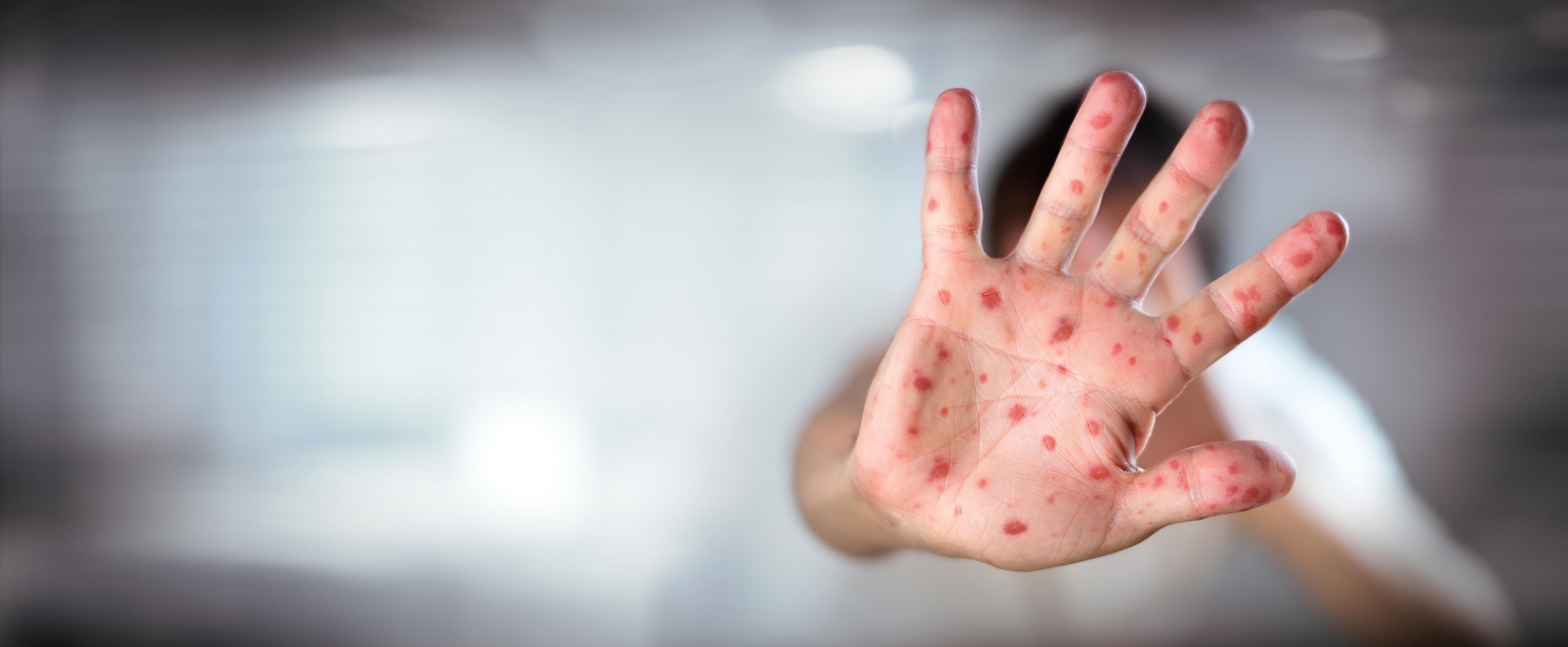 Update: 11 measles cases confirmed by State Health and Human Services