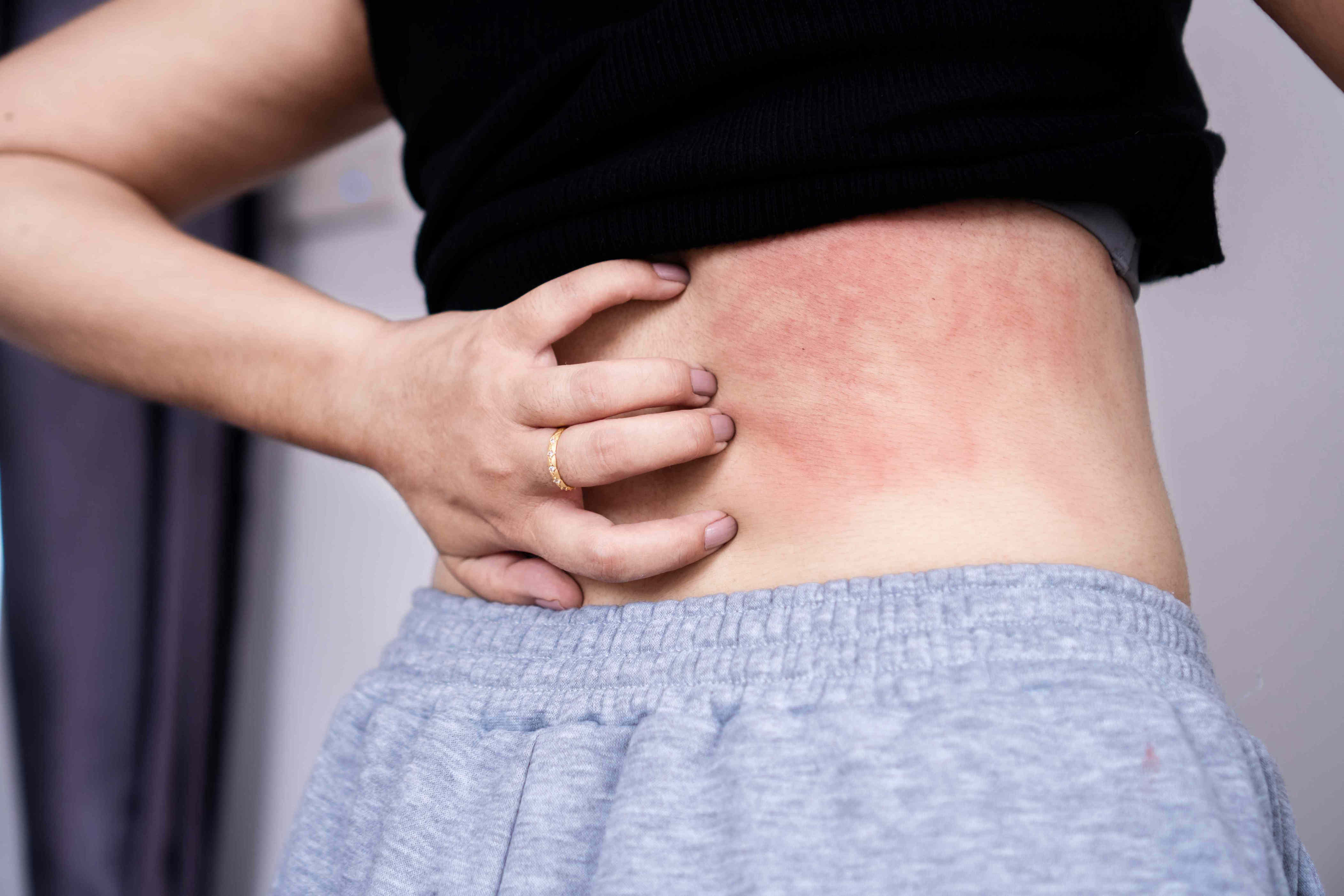 How long do chronic spontaneous urticaria symptoms last?