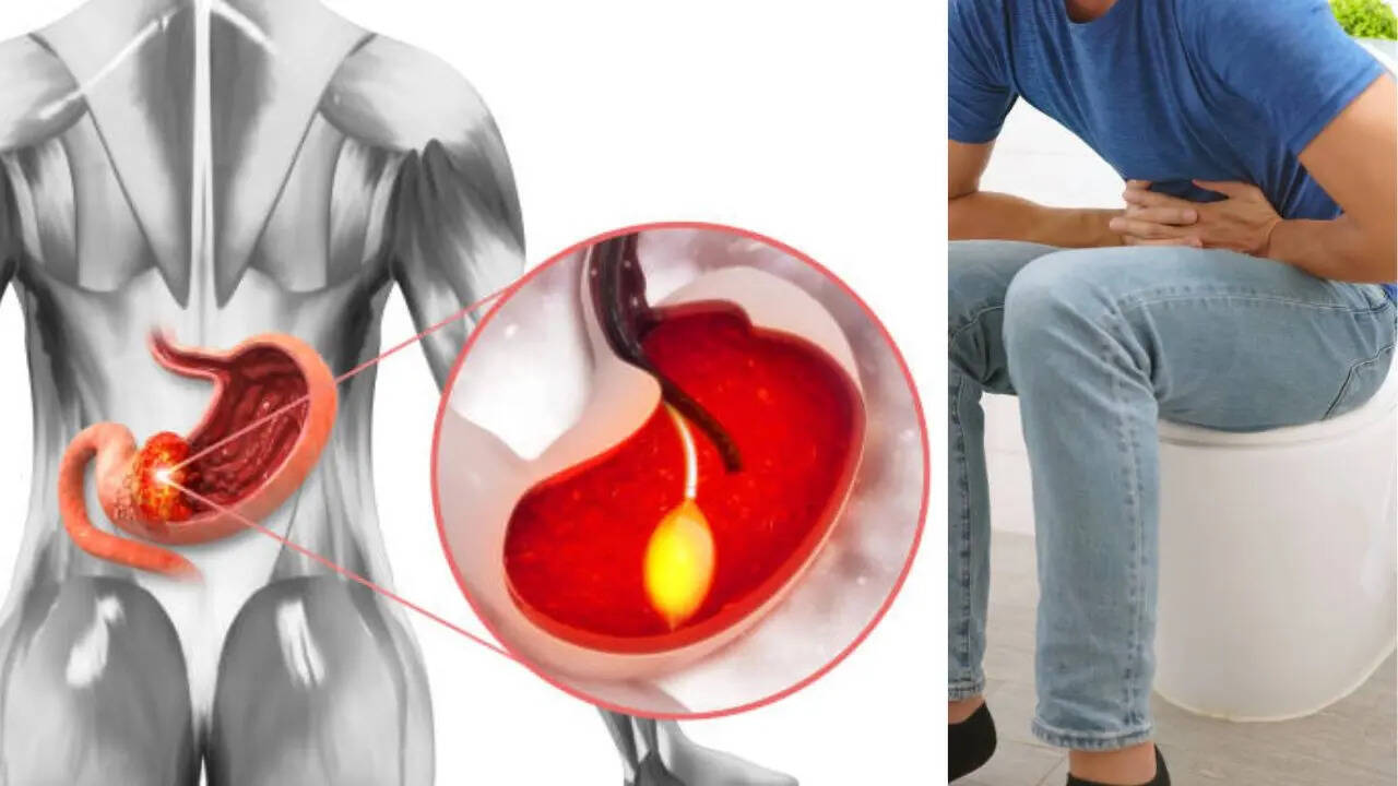 What is GIST, the rare stomach cancer tumour that can turn deadly if missed