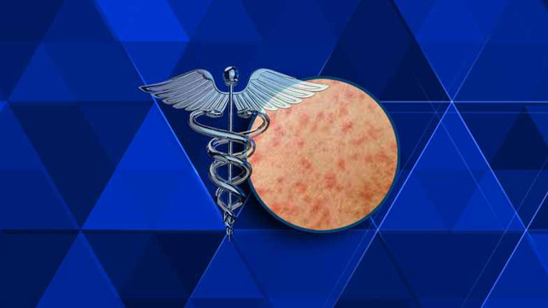 Second measles case confirmed in Madison