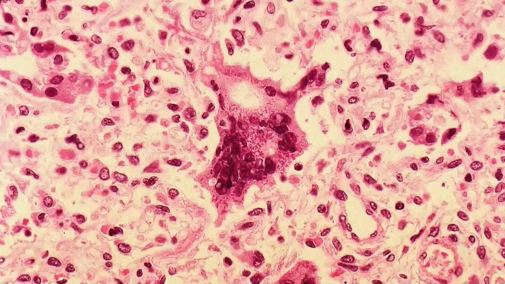 Riverside County health officials report second and third measles cases