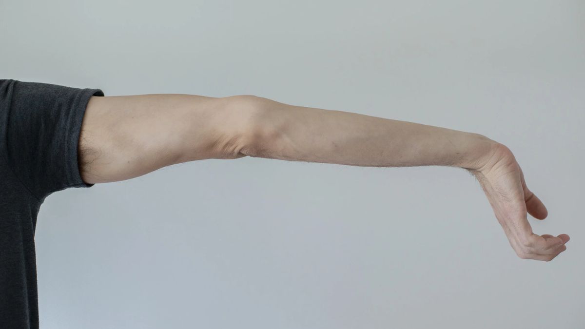 What is Usman Tariq’s double elbow? Doctor explains the rare double ...