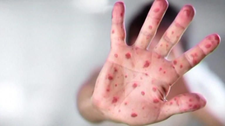 Florida ranks 3rd for the most measles cases in the US.: CDC