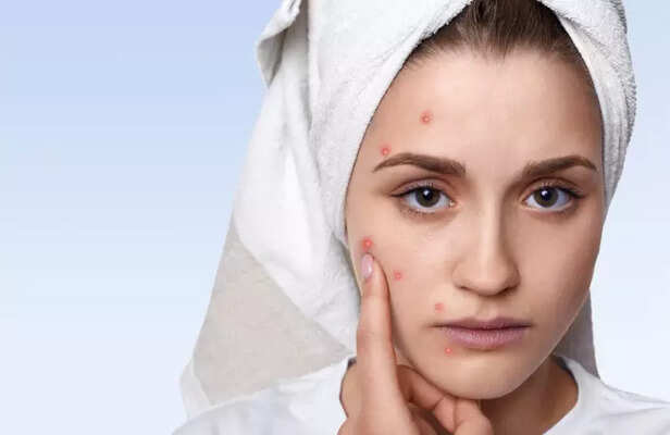 You’re treating pimples wrong dermatologists warn about this mistake