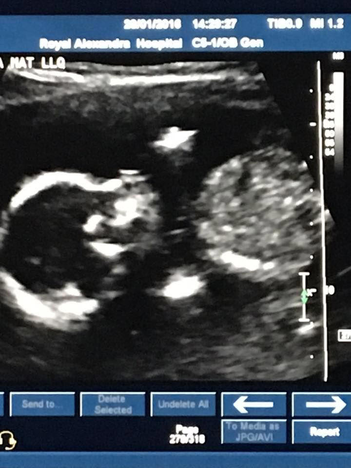 Routine scan reveals four surprise babies