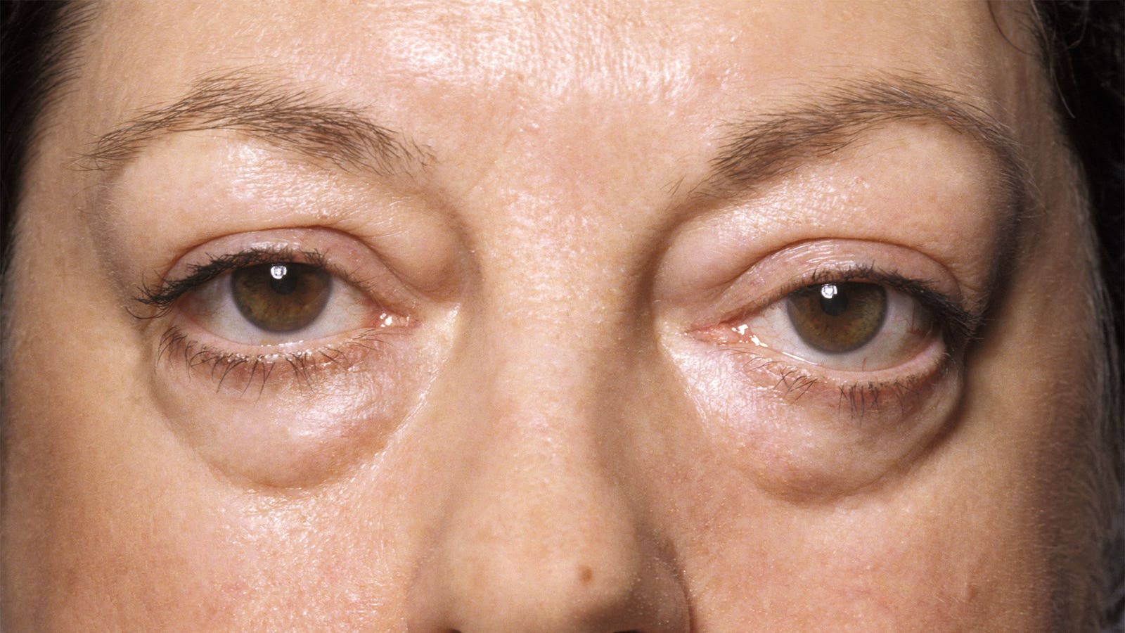 Link between low-risk HPV and thyroid eye disease