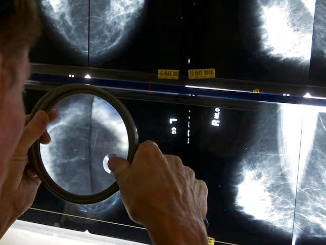 Les jeunes survivants du cancer sont plus susceptibles d’en développer ...